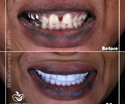 Misalignment Of Teeth Hannover Medical Center Sharjah
