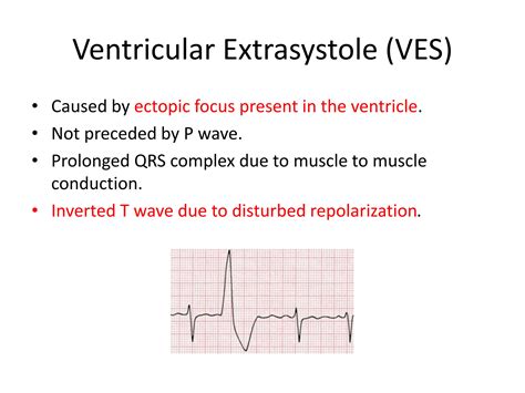 Ekg Dasar Aritmia Svt Vt Av Blockppt