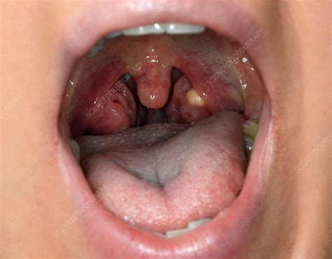 Tonsil Cyst Stock Image C018 1018 Science Photo Library