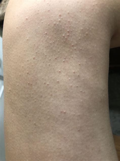 Cant Get Rid Of Small Bumps R30plusskincare