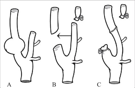 Aneurysm Resection With Transposition Of The Eca To Ica A Ecaa