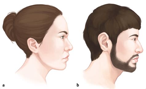 Chapter 12 Chin Augmentation Plastic Surgery Key