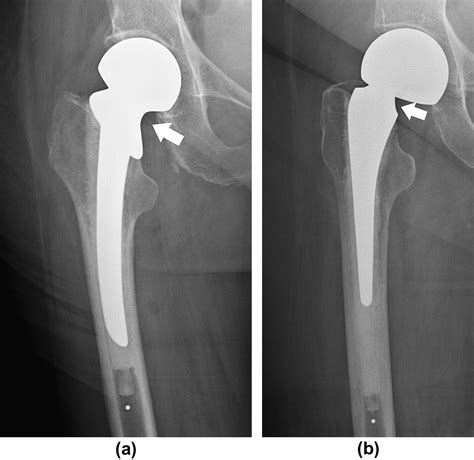 Hip Arthroplasty Part 1 Prosthesis Terminology And Classification Clinical Radiology