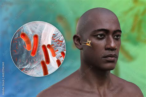 Otitis Media Ear Infection 3d Illustration Stock Illustration Adobe