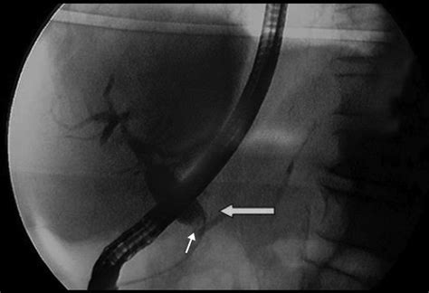 Litiasis Y Estenosis Del Colédoco Provocada Por La Migración De Un Clip