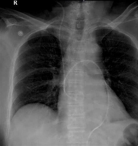 A Rare Case Of Spinal Tumor Syndrome With Pericardial Effusion