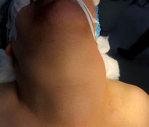 Large Toxic Multinodular Goiter Total Thyroidectomy Jun 2021 Dr