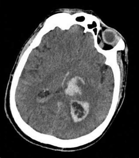 Odd Hemoventricle Pattern Masking Bilateral Trigone
