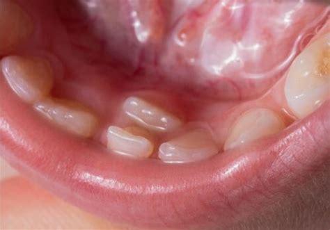 Hyperdontia Understanding The Phenomenon Of Supernumerary Teeth