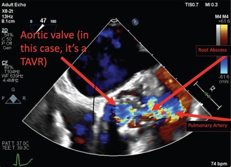 Ruptured Root Abscess With Aortopulmonary Fistula Caused By Vancomycin