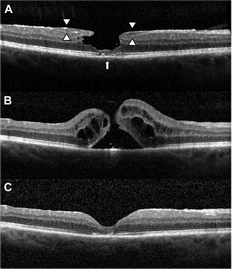 Natural History And Surgical Outcomes Of Lamellar Macular Holes