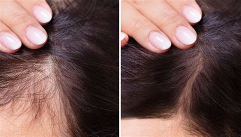 Effective Solutions For Hair Loss