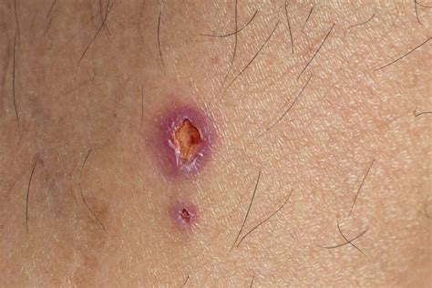 Understanding Hypergranulation And How Its Treated Dfw Wound Care