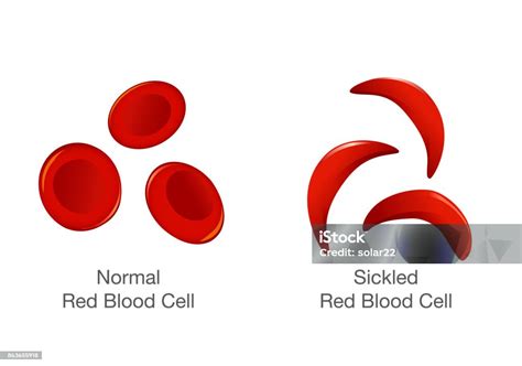 Perbedaan Sel Darah Merah Normal Dan Sel Sabit Ilustrasi Stok Unduh