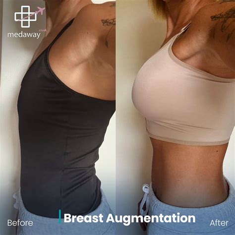 Boob Job Before And After Up To 15 Off Packages Medaway