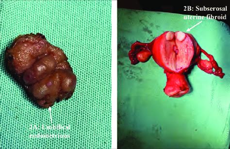 A Excised Umbilical Nodule With Endometriosis White Arrow B