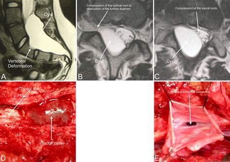 Treatment Of Symptomatic Sacral Arachnoid Cysts In The Pediatric