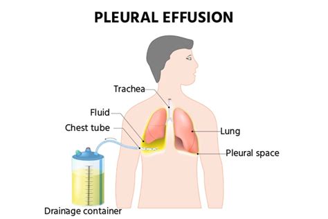 Pleural Effusion Treatment