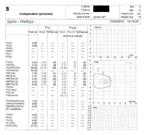 A Preoperative Flow Volume Loop Demonstrating Flattening Of The Download Scientific Diagram