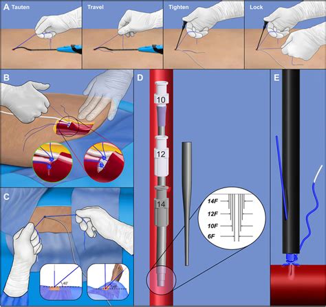Suture Mediated Intermediate And Terminal Closure When Using The Aortix