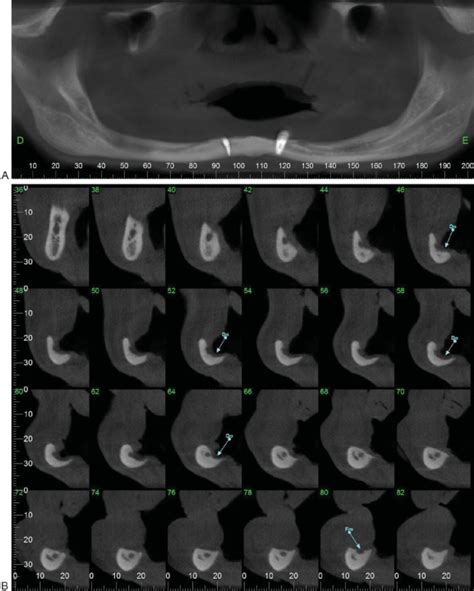 A C Ct Scans Showing A Type Ii Severely Atrophic Mandible With