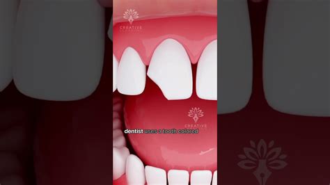 Chipped Incisor Fix It Fast Emergency Guide Inside Learnfastblog