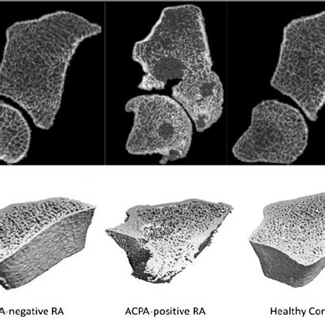 High Resolution Peripheral Quantitative Computed Tomography Hr Pqct