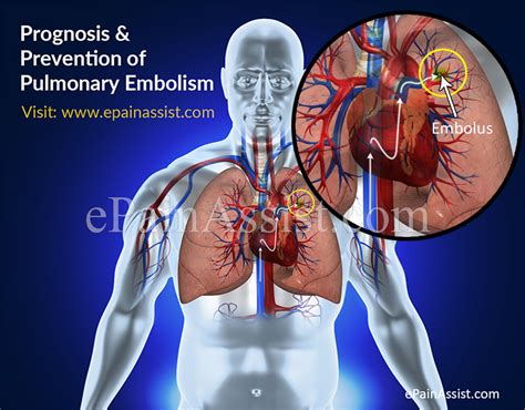 Prognosis And Prevention Of Pulmonary Embolism