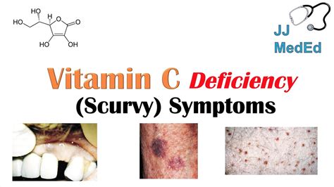 Vitamin C Deficiency Vitamin C Deficiency Symptoms Consequences And