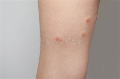 Female Leg With Skin Problem Close Up Infectious Disease Allergy