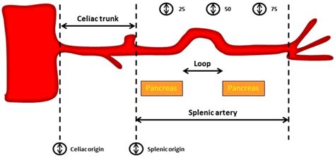 Splenic Artery Model