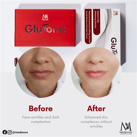 Glutone 10 Capsules For Glowing And Healthy Skin Medevox Aesthethics