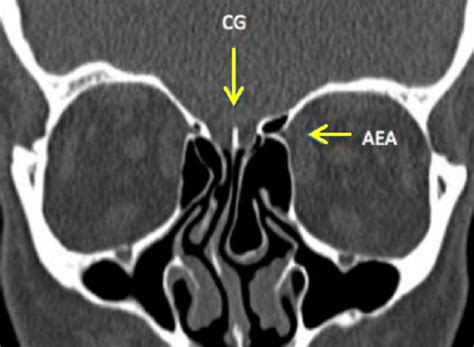 4 9 Endoscopic Ethmoidectomy Fess Surgical Technique Medicine Libretexts