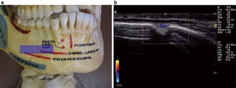 Ultrasound Guided Superficial Trigeminal Nerve Blocks Nysora
