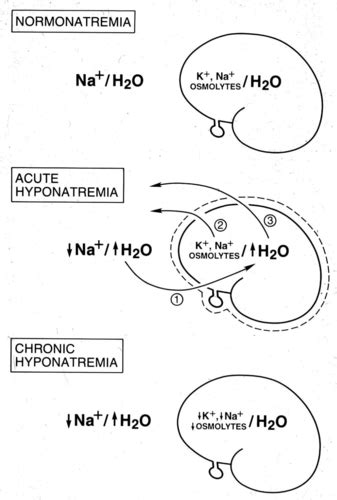 Exercise Associated Hyponatremia Flashcards Quizlet