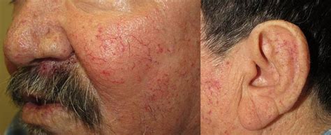 Multiple Arborizing Telangiectases On The Cheek And Ear Download