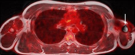 Metallic Hardware In A 17 Year Old Boy With Left Humeral Osteosarcoma
