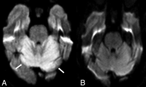 Potentially Reversible And Recognizable Acute Encephalopathic Syndromes