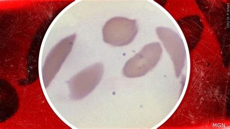 Two Gene Therapy Approaches Approved For Sickle Cell Disease Articles