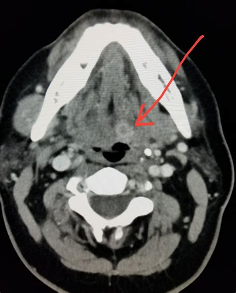 Face Ct Shows Thyroid Tissue That Developed In The Wrong Location Ectopic Lingual Thyroid