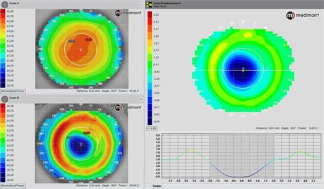 Dont Forget About Myopia Progression In Adults Insight