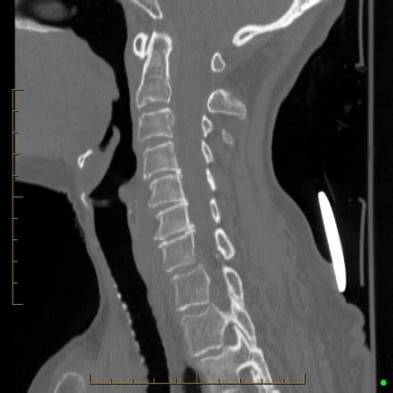Odontoid Fracture