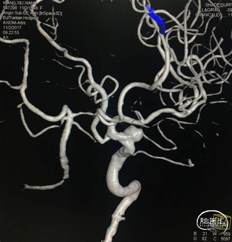 颅内动脉瘤微导管塑形演义（六） 脑医汇