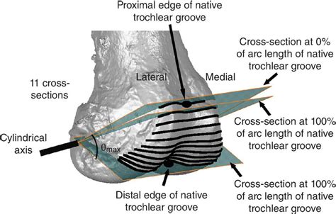 Strategies For Improving The Prosthetic Trochlea Design Based On