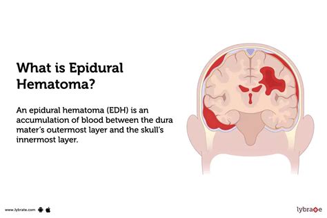 Epidural Hematoma Causes Symptoms Treatment And Cost
