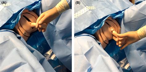 Breech Extraction Of A Second Twin Clinical Tree