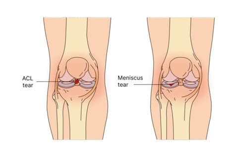 Acl Vs Meniscus Tear Symptoms Diagnosis And Daily Impact