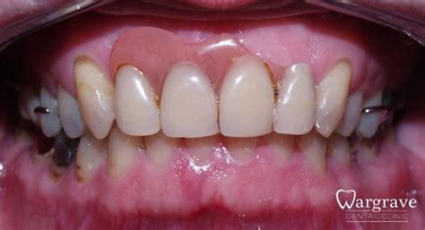 Partial Dentures Wargrave Dental Clinic