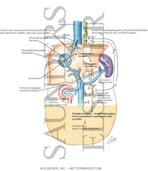 Pathophysiology Of Ascites Formation