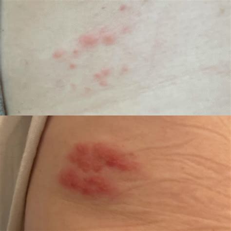 Thought It Was Bug Bites Then I Thought It Was Heat Rash But Nope It